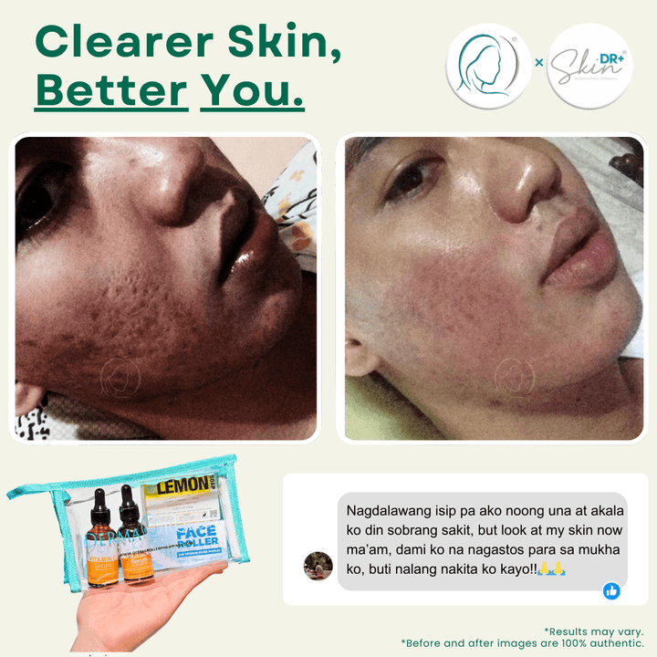 Derma Roller Philippines | Original Microneedling & Skincare Tools